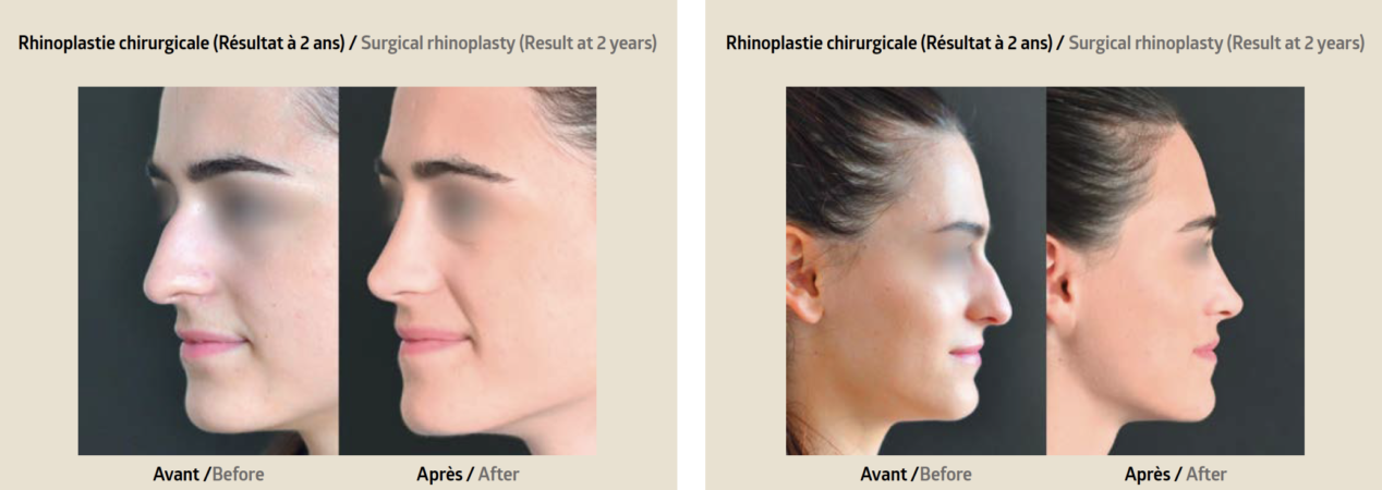 Anatomical conservative rhinoplasty: technique and benefits – Anti Age ...