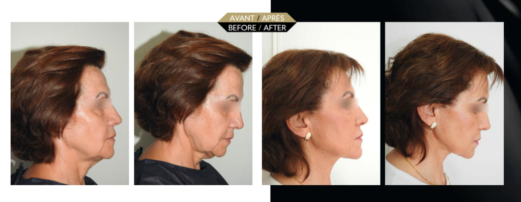 The MICRO-Lift – Anti Age Magazine