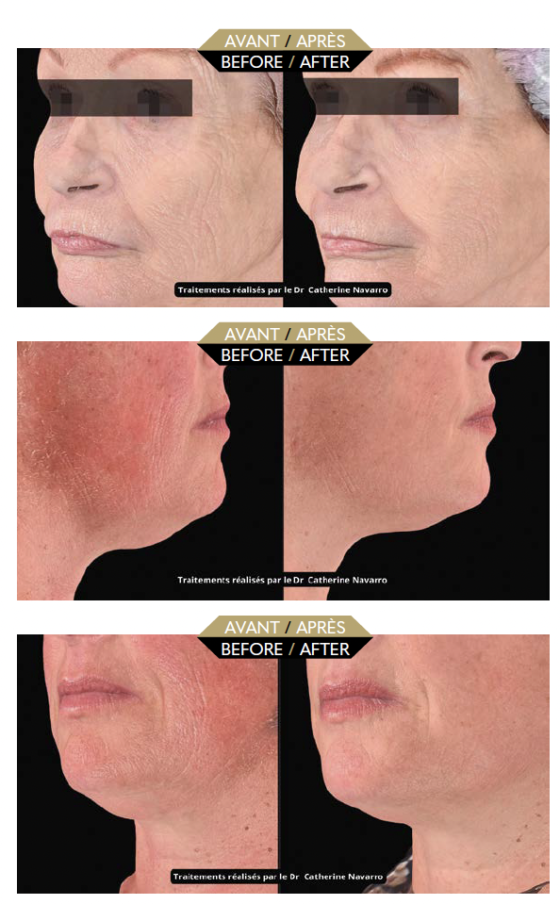 Combining the procedures EMFACE® and EXION™ – Anti Age and Longevity ...